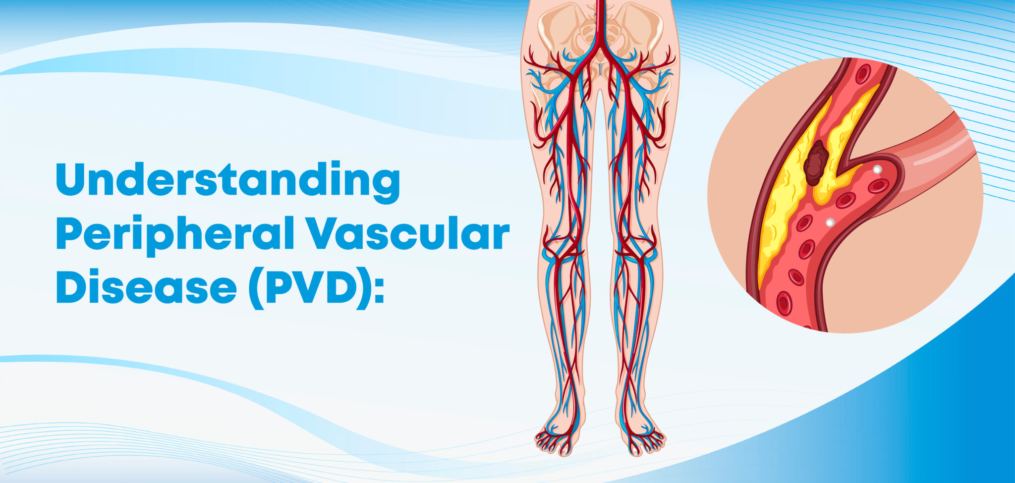 Understanding Peripheral Vascular Disease (PVD)